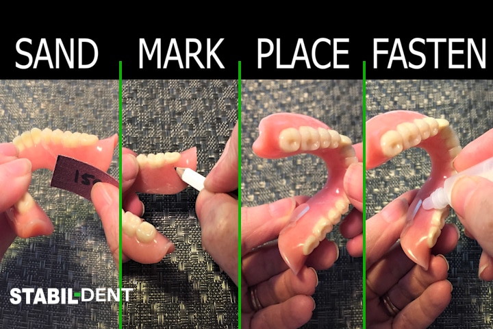What Is A Stabil Denture? , Complete Dentures Anatomy of the Denture ...