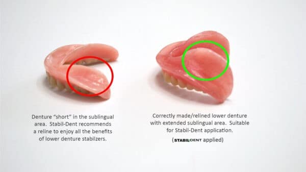Denture Stabilization And Your Lower Denture-Stabildent